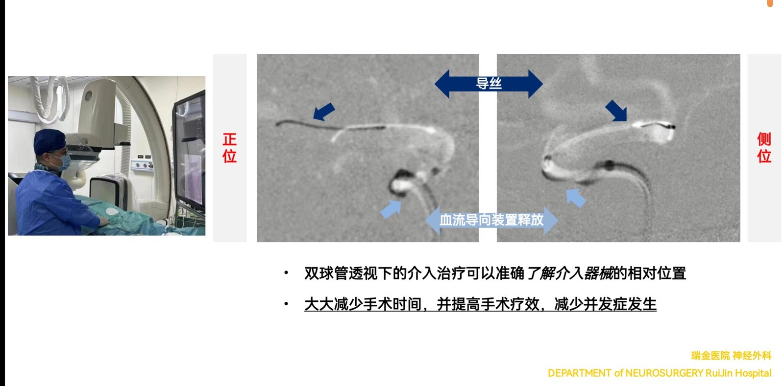 双球管DSA在神经外科血管介入中的核心优势：全面提升手术安全性_神经介入_神经介入治疗介绍 - 好大夫在线