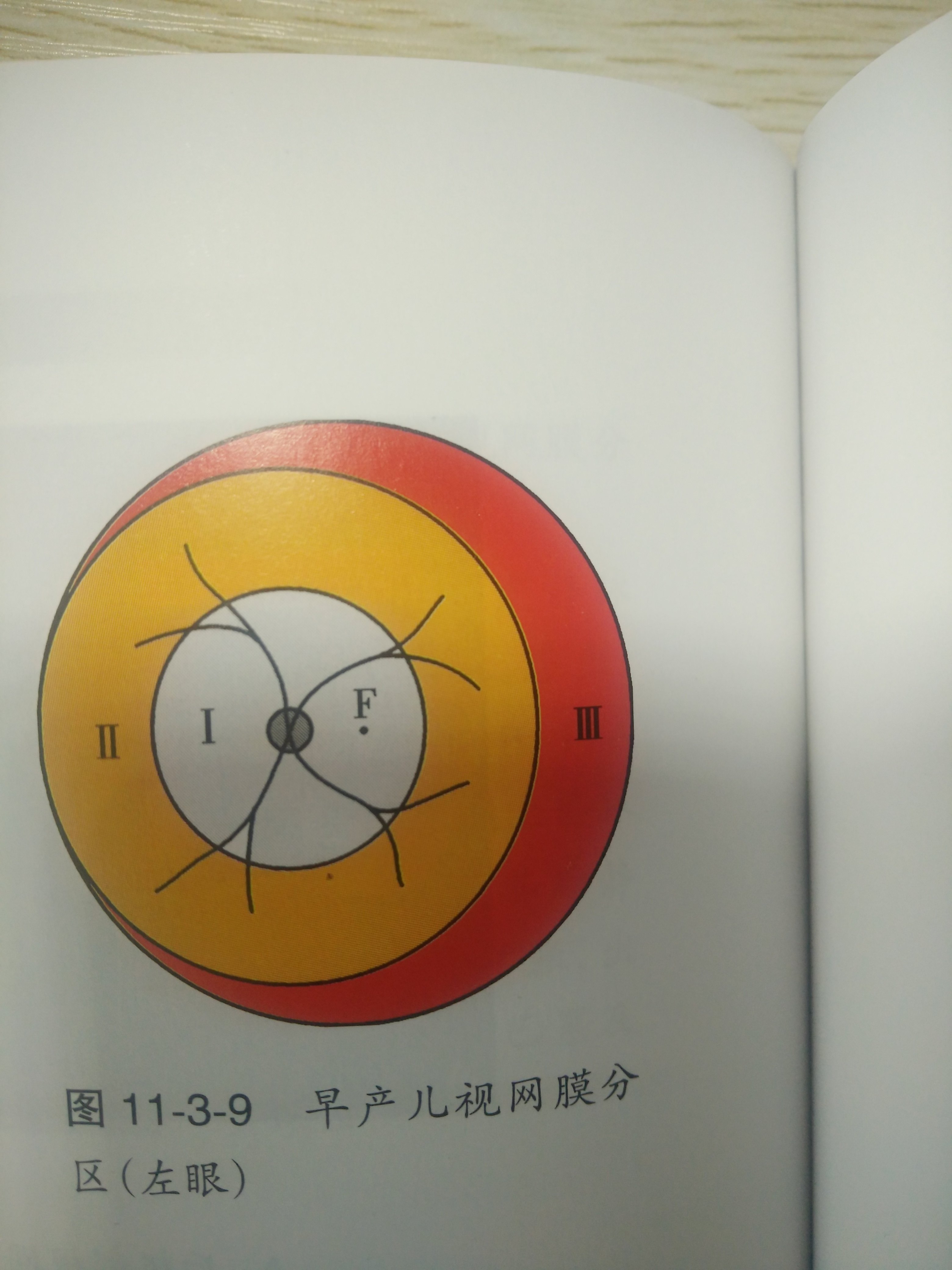 早产儿视网膜病变（ROP）的分区和分期 - 好大夫在线