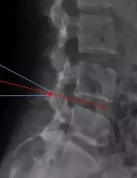 腰椎微创技术之二：UBE-ULBD技术治疗腰椎间盘突出症腰椎管狭窄症 - 好大夫在线