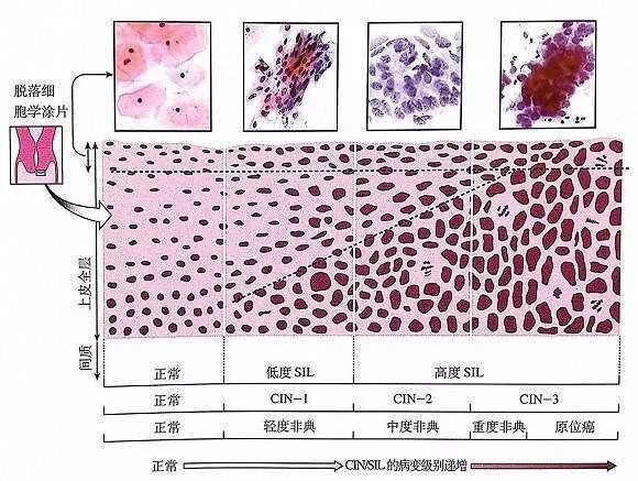 冷刀锥切（CKC）和宫颈环形电切（LEEP）谁更优？_宫颈锥切术_宫颈锥切术治疗介绍 - 好大夫在线