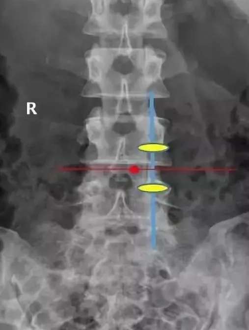 腰椎微创技术之二：UBE-ULBD技术治疗腰椎间盘突出症腰椎管狭窄症 - 好大夫在线