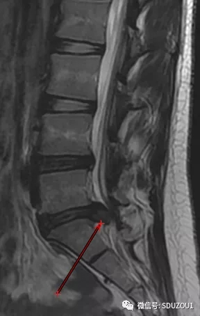 腰椎微创技术之二：UBE-ULBD技术治疗腰椎间盘突出症腰椎管狭窄症 - 好大夫在线