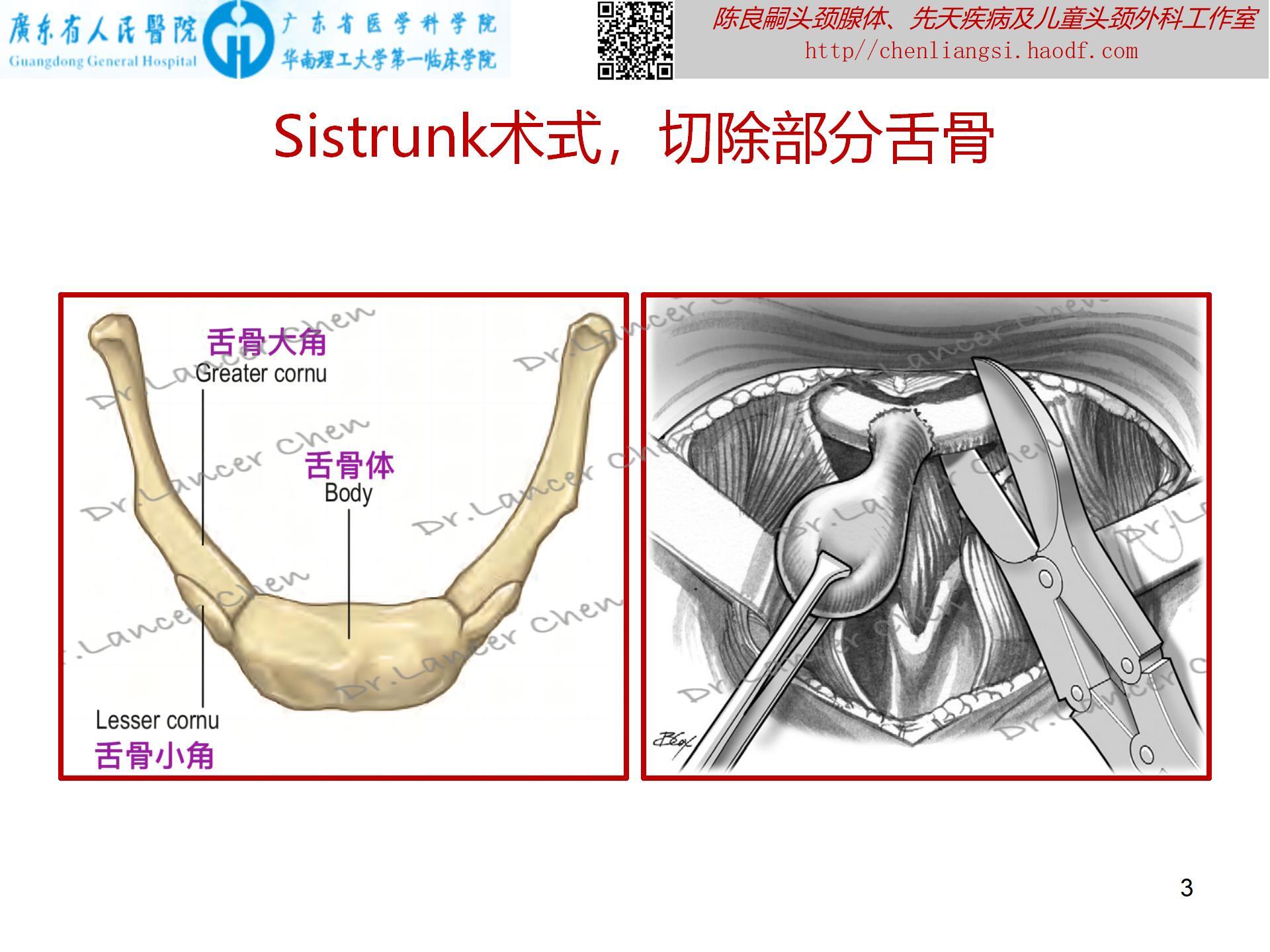 医学科普——经典恒久远，百年永传承：甲状舌管囊肿手术标准程序——Sistrunk术式 - 好大夫在线