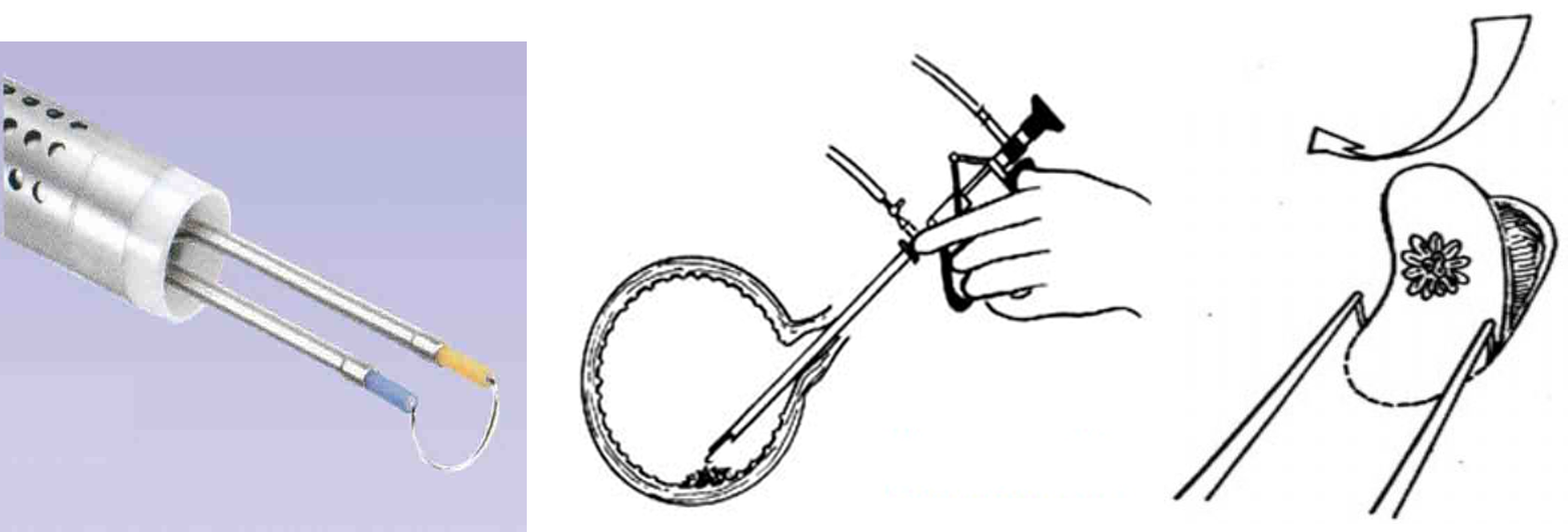 非肌层浸润膀胱癌的手术方案，从TURBt到ERBT的前世今生_膀胱癌_膀胱癌治疗方式 - 好大夫在线