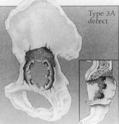 髋臼骨缺损的Paprosky分型_全髋关节置换翻修的植骨原则：髋臼技术(1994)_髋关节置换术_髋关节置换术治疗介绍 - 好大夫在线