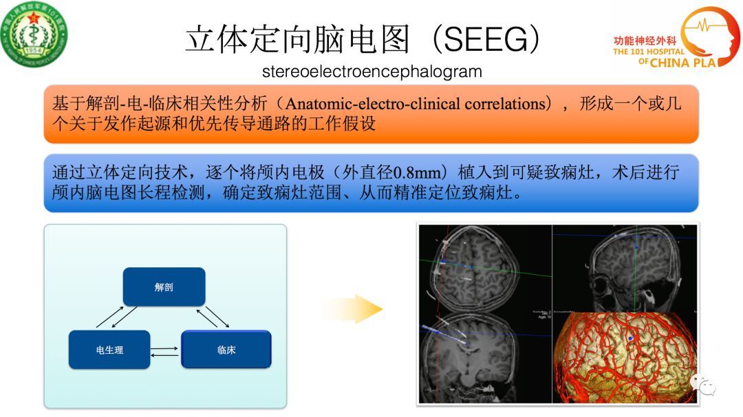 颅内深部脑电图（SEEG）在难治性癫痫中的作用（PPT） - 好大夫在线
