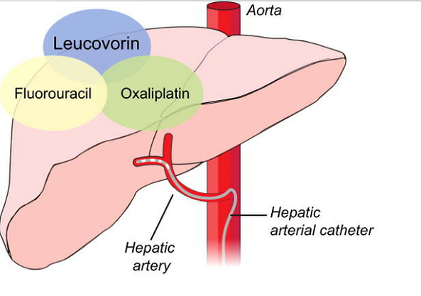 肝动脉灌注化疗（HAIC）在肝脏恶性肿瘤的临床应用_肝癌介入_肝癌介入治疗介绍 - 好大夫在线