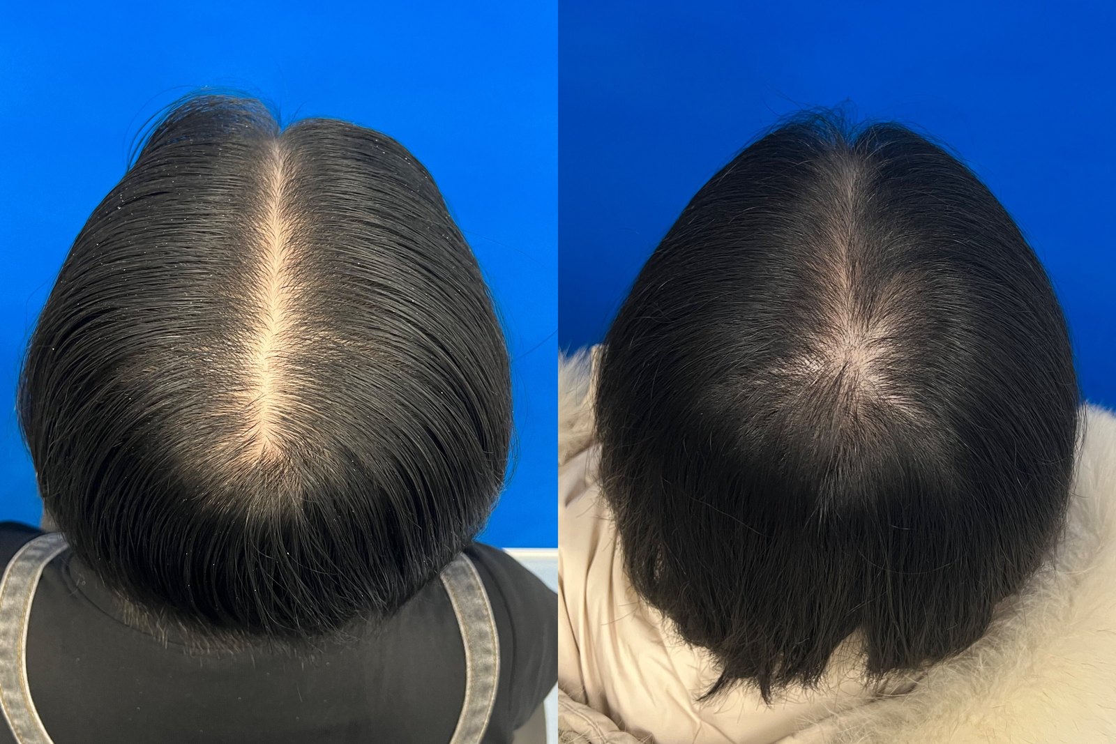 案例分享：女性型脱发-CGF治疗 CGF（Concentrated Growth Factors） - 好大夫在线